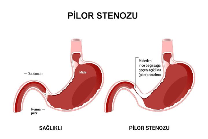 Pilor Stenozu (Pilor Darlığı) - Bebek Hastanesi